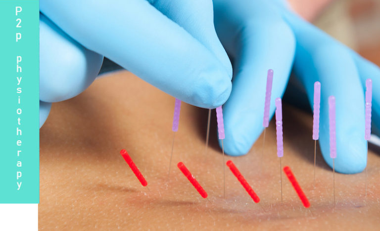 Dry Needling | Dry Needle Therapy | Point 2 Point Physiotherapy